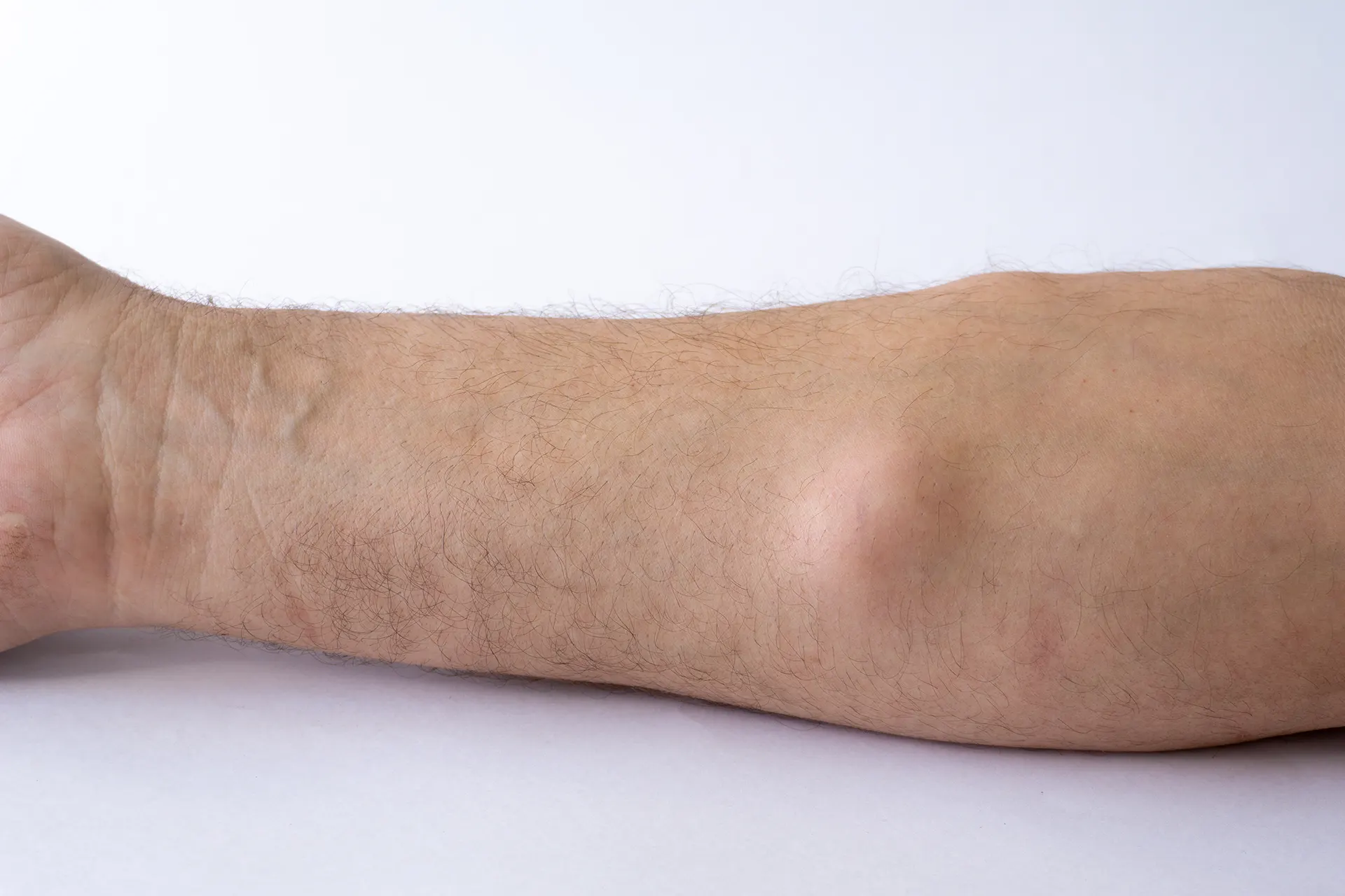 Uklanjanje lipoma, ateroma, gangliona - Poliklinika Arthros